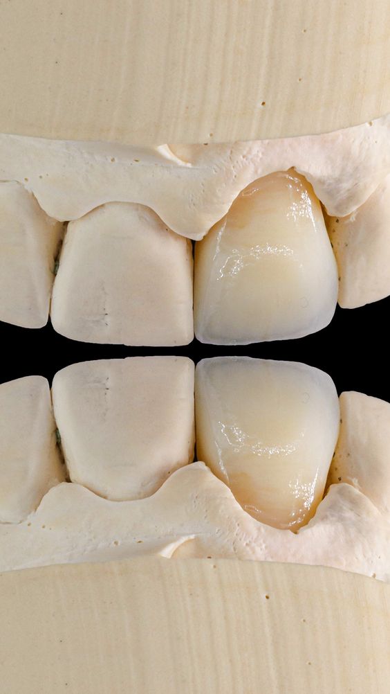 Lithium Disilicate and Zirconia: Dissecting the Differences